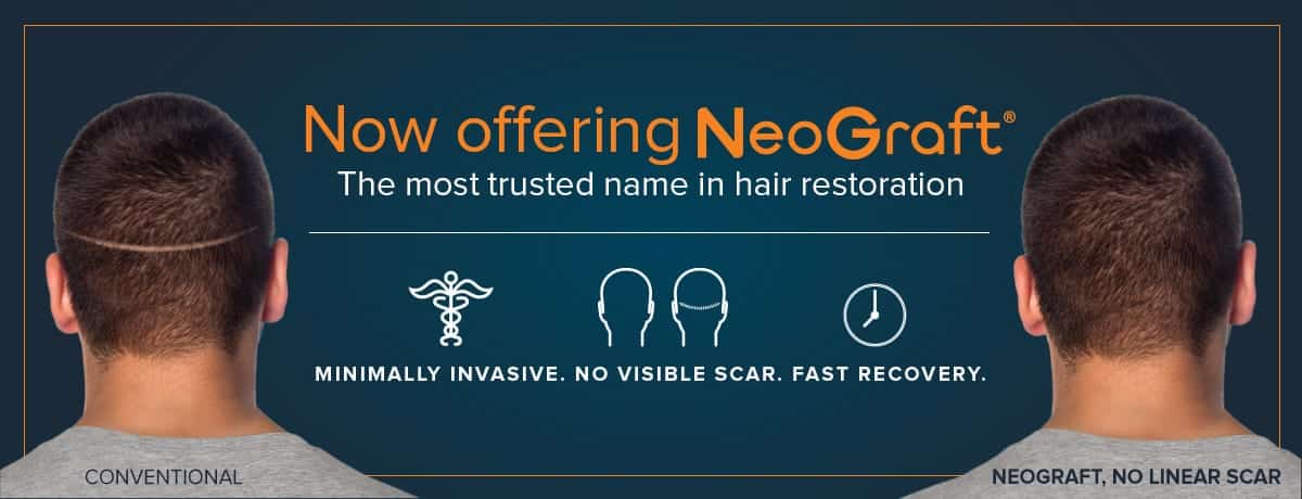 NeoGraft Hair Restoration Chicago | FUE Hair Transplant illinois